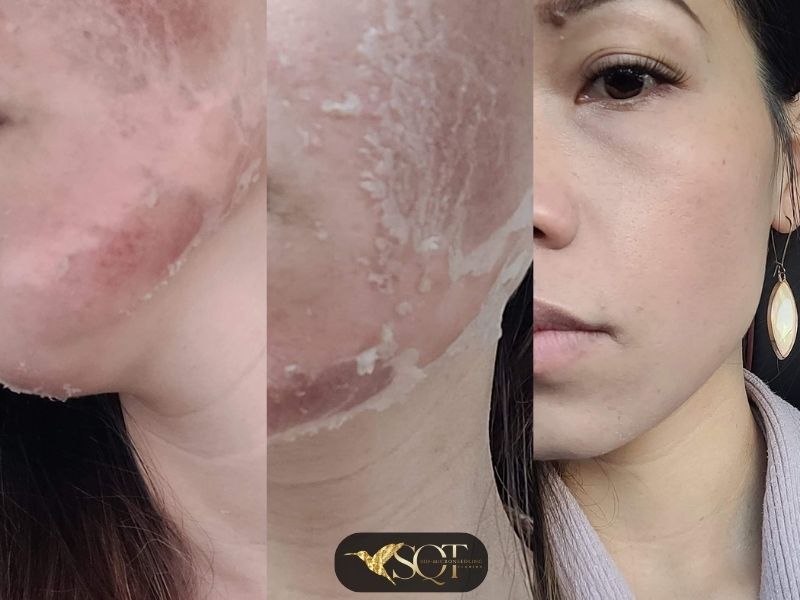 SQT Bio Microneedling USA | Advanced Skincare Solutions