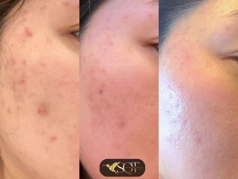 SQT Bio Microneedling USA | Advanced Skincare Solutions